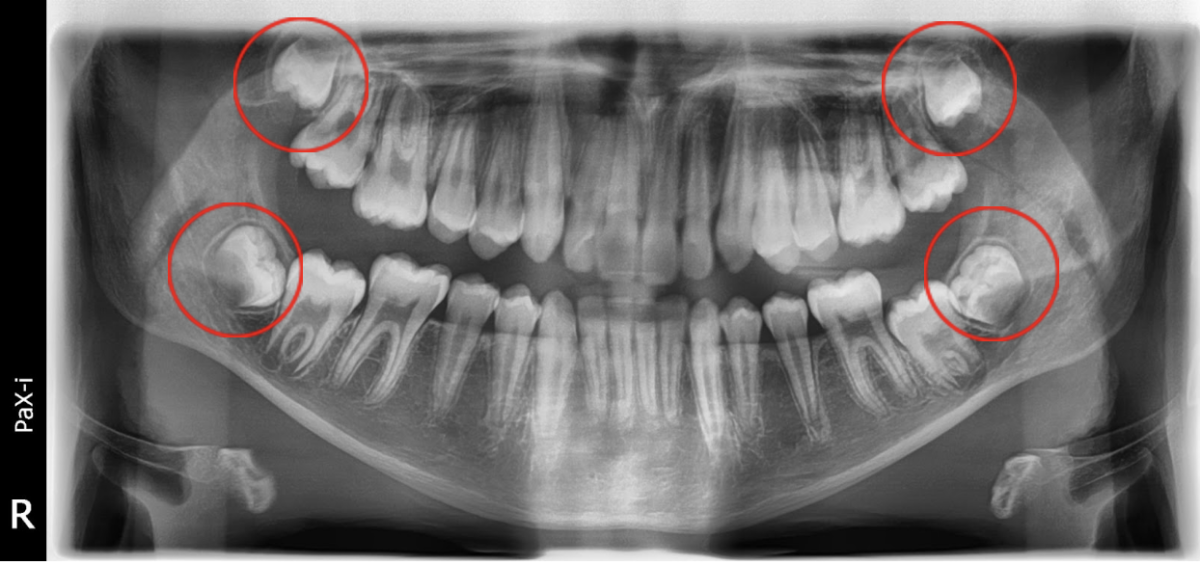 Should They Stay or Should They Go Now? - Downtown Dental