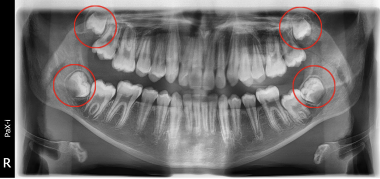 Should They Stay or Should They Go Now? - Downtown Dental